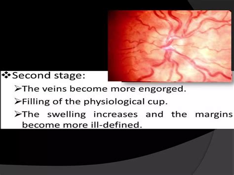 Optic Nerve Pappiloedema Clinical Round Ppt Free Download