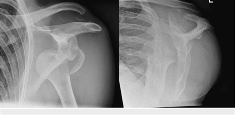 Figure 1 From Proximal Humerus Fracture Dislocation Look For The Greater Tuberosity Semantic