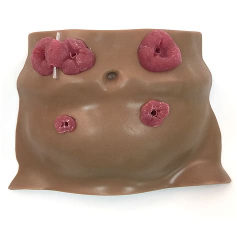 Colostomy Stoma Healthy