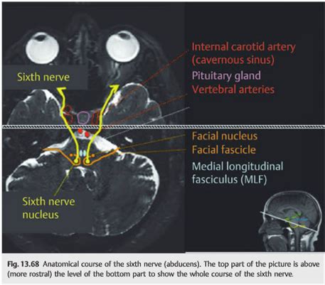 Cranial Nerve 6 Anatomy My XXX Hot Girl