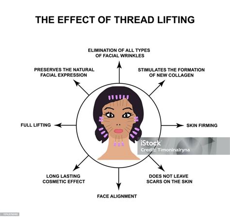 스레드 리프팅의 효과 페이스리프트용 나사 메조테라피 주름 인포 그래픽 격리된 배경에 대한 벡터 그림입니다 건강관리와 의술에 대한 스톡 벡터 아트 및 기타 이미지 Istock