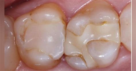 Reducing Recurrent Caries In Composite Restorations Dental Economics
