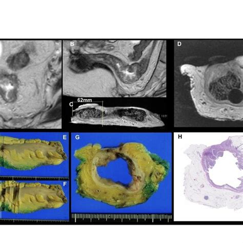 Mri Of Resected Specimen Smr And Formalin Fixation And Slicing Axial Download Scientific