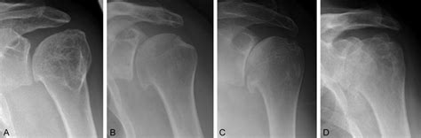 Four Level Scale For Glenoid Erosion Assessment None A Mild B Download Scientific