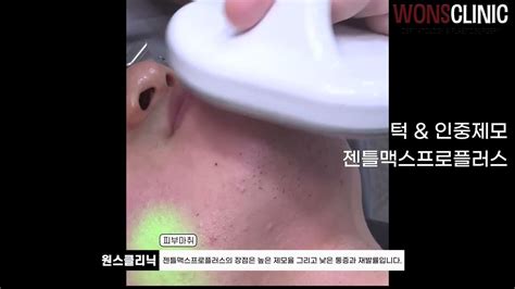 젠틀맥스프로플러스 20240330 턱인중제모 수원 원스의원 Youtube