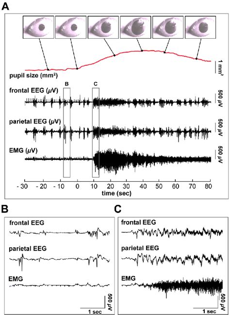 Pupil Dilation Precedes Burst Of Eeg A A Representative Trace Of
