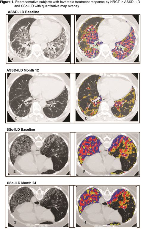 Quantitative Scoring Of High Resolution Chest Computed Tomography Hrct Images In Myositis And