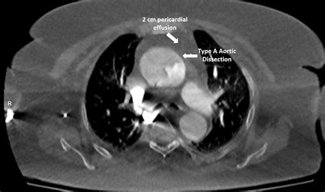 Preoperative Contrast Enhanced Computed Tomography Image Acute Type A