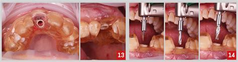 Guided Immediate Implant Placement And Immediate Loading In The Esthetic Zone C Tech Implant