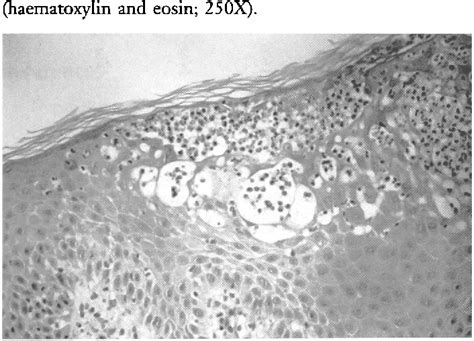 Figure 1 From Pyodermatitis Pyostomatitis Vegetans Two Cases And A Review Of The Literature