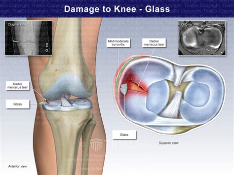 Damage To Knee Glass Trialquest Inc