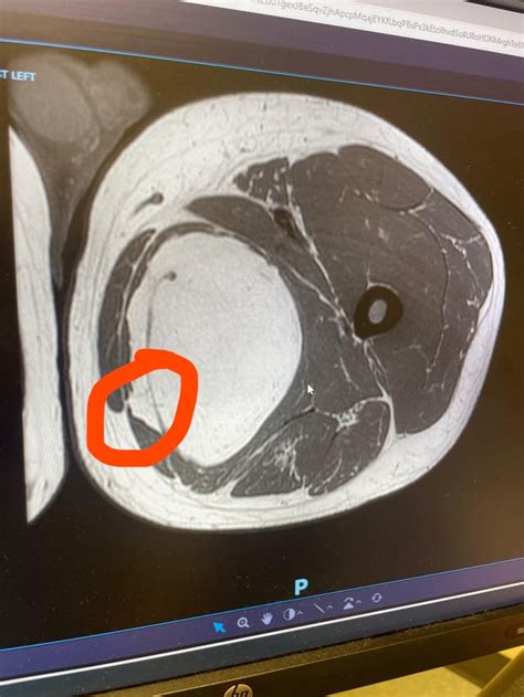 Had My Surgery May 6th 18cm X 11cm Excision R Lipoma