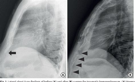 Figure 1 From Heterotopic Ossification Of The Xiphoid Process After