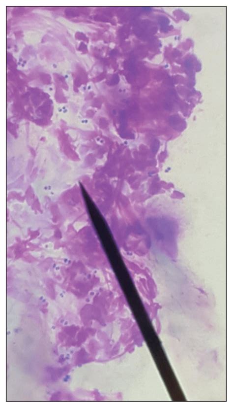 Treating Pyoderma Without The Use Of Systemic Antibiotics Abstract