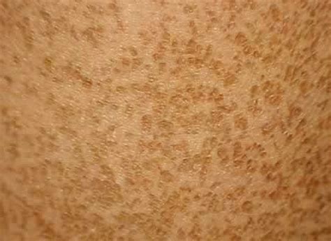 Пигментация Кожи На Ногах Фото —