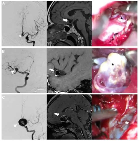 华山医院首次揭示脑动脉瘤壁高分辨磁共振显像（hrvwi）所代表的病理结构 脑医汇