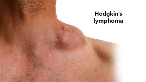 Symptoms Of Hodgkins Lymphoma Medizzy