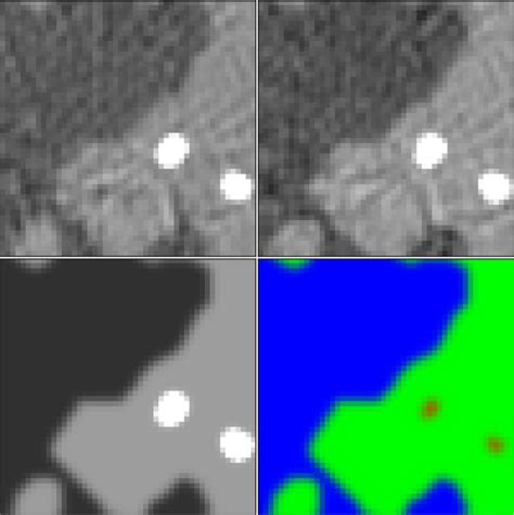 Deep Learning For Inverse Problems Spectral Computed Tomography Image Reconstruction Dl