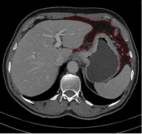 Figure 2 From Practical Nomogram Based On Comprehensive Ct Texture