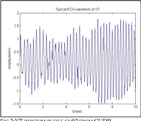 Figure 2 From A Shockable Rhythm Detection Algorithm Using Slope