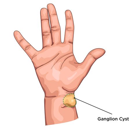 Ganglion Cyst Wrist Pins And Needles At Beau Caffyn Blog