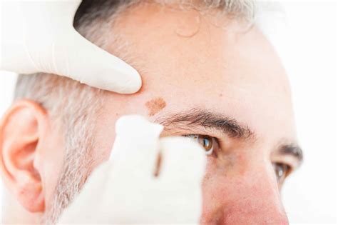Skin Cancer On Face What Does It Look Like