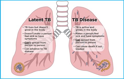 HIV And Tuberculosis TB NIH