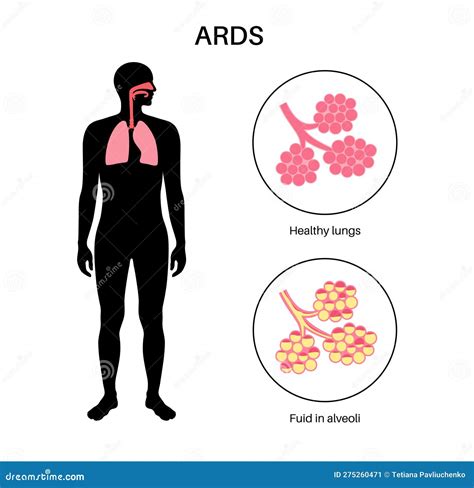 Ards Anatomical Poster Cartoon Vector 275260471