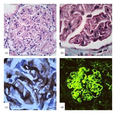 Lupus Nephritis Class V A Significant Glomerular Capillary Wall