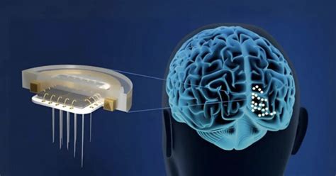 ‘뇌 임플란트 칩이 시력도 되찾아줄까