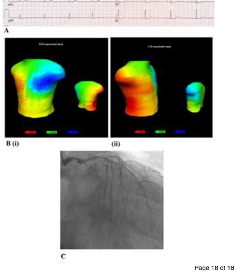 Table 1 From Pre Hospital Body Surface Potential Mapping Improves Early Diagnosis Of Acute