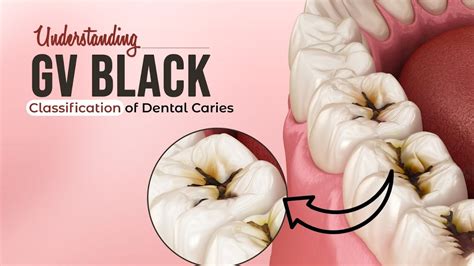 Understanding Gv Black Classification Of Dental Caries Dentalkart