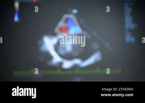 Blurred Background Utrasound Image On Monitor Ultrasound Scan Display Screening
