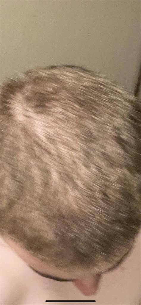 17m Diffuse Thinning Early Stage Decided To Buzz Thoughts R Malehairadvice