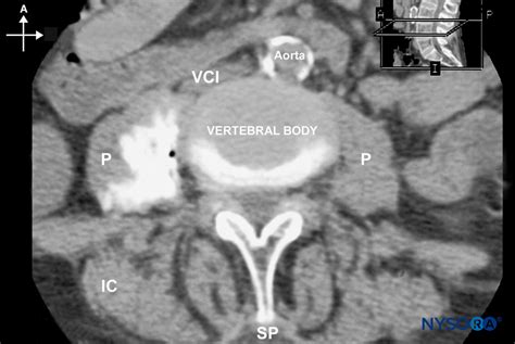 Regional Anesthesia An Mri Image Demonstrating The Distribution Of