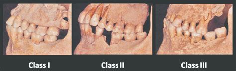 Angle´s Occlusion Classification Download Scientific Diagram