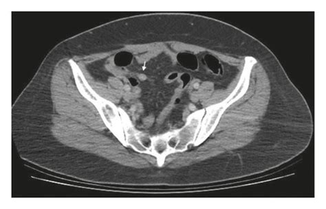 Suspicious Mass Appearance In The Distal Of The Appendix White Arrow