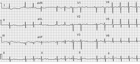 Figure Figure3 A 12 Lead Electrocardiogram Shows Statpearls Ncbi Bookshelf