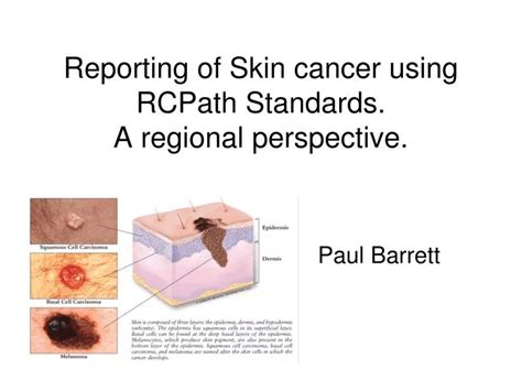 Ppt Reporting Of Skin Cancer Using Rcpath Standards A Regional