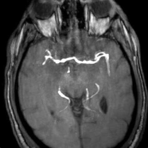 Mr Angiogram Demonstrating Multifocal Narrowing Of Bilateral Mca M1