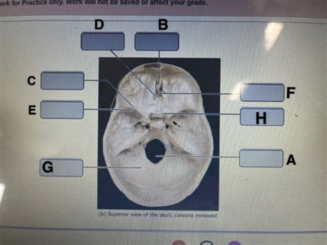 Bone Practical Flashcards Quizlet