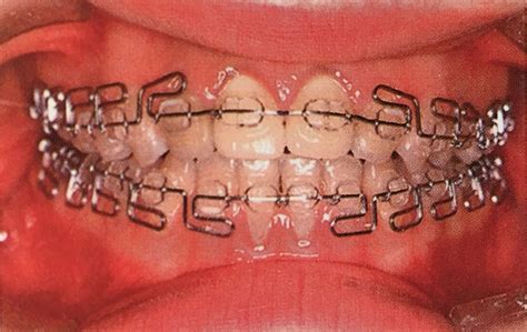 Edgewise Appliance Orthodontics Elrhov