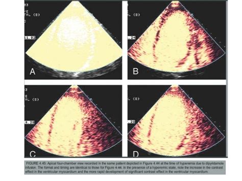 The Hibernating Myocardium