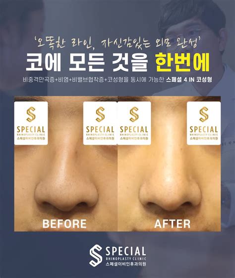 코성형 고민이라면 아묻따 👍👍👍👍 유명연예인들 셀럽 아나운서들이 입소문으로 믿고 진료받는 스페셜👏👏 건강하고 아름다운 코성형코질환에 대한 모든것 이젠 7000