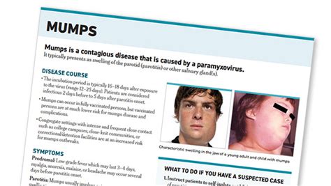 Mumps Clinical Diagnosis Fact Sheet Mumps Cdc