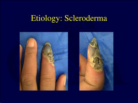 Ppt Upper Extremity Amputation Powerpoint Presentation Free Download Id 3942066