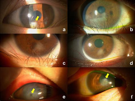 Photos Of Slit Lamp Examination A Corneal Scarring Arrow B And C Download Scientific