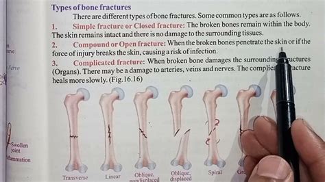 Complicated Fracture