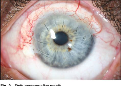 Figure 1 From Fuchs Superficial Marginal Keratitis Managed With