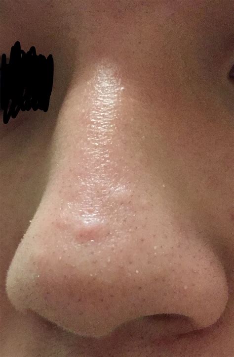 Raised Scar On Nose How Can I Get Rid Of It W Pics Acne Scars Acne Org Forum